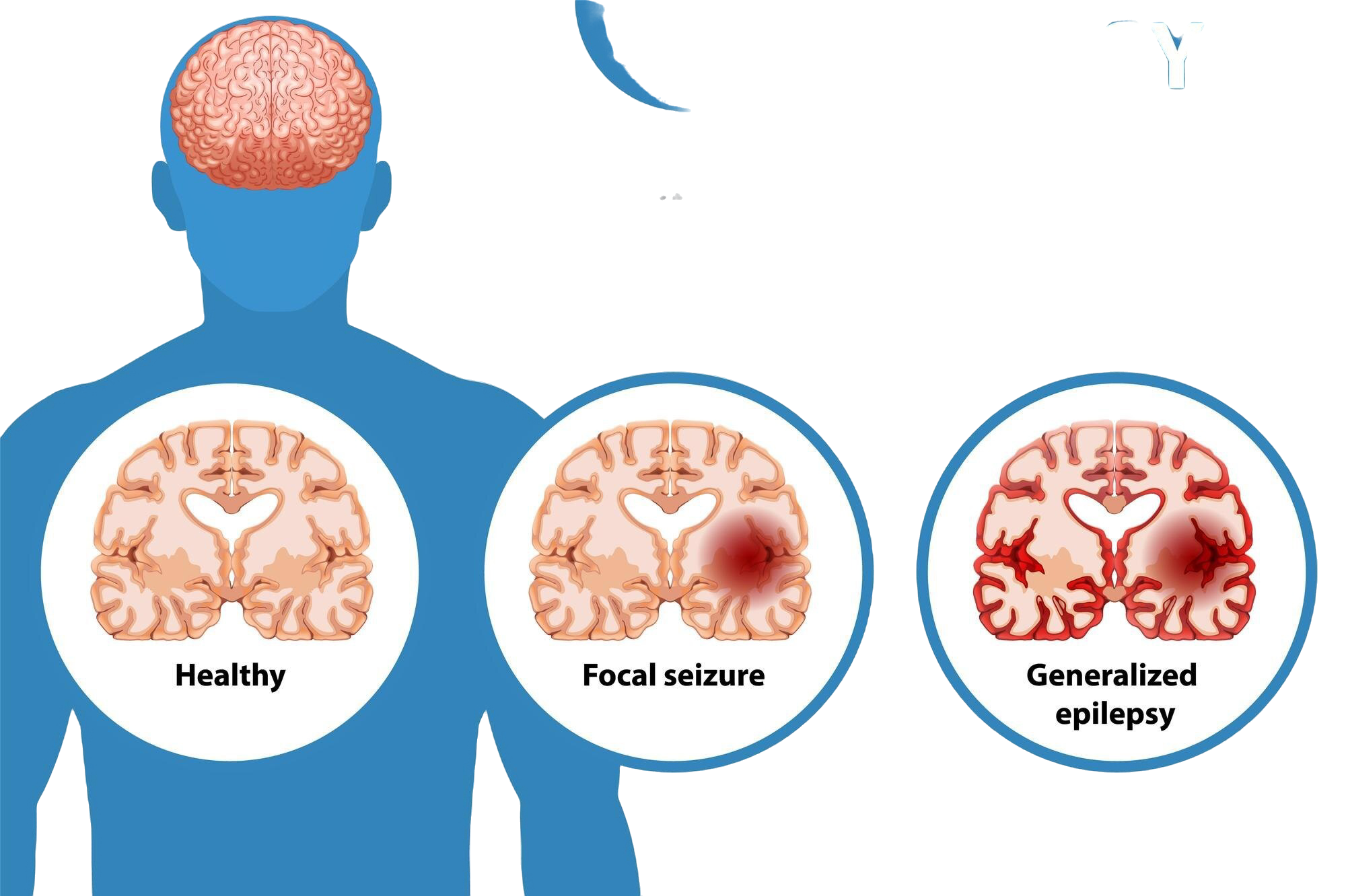 Understanding Epilepsy: Causes, Symptoms, and Prevention Tips | Dr ...